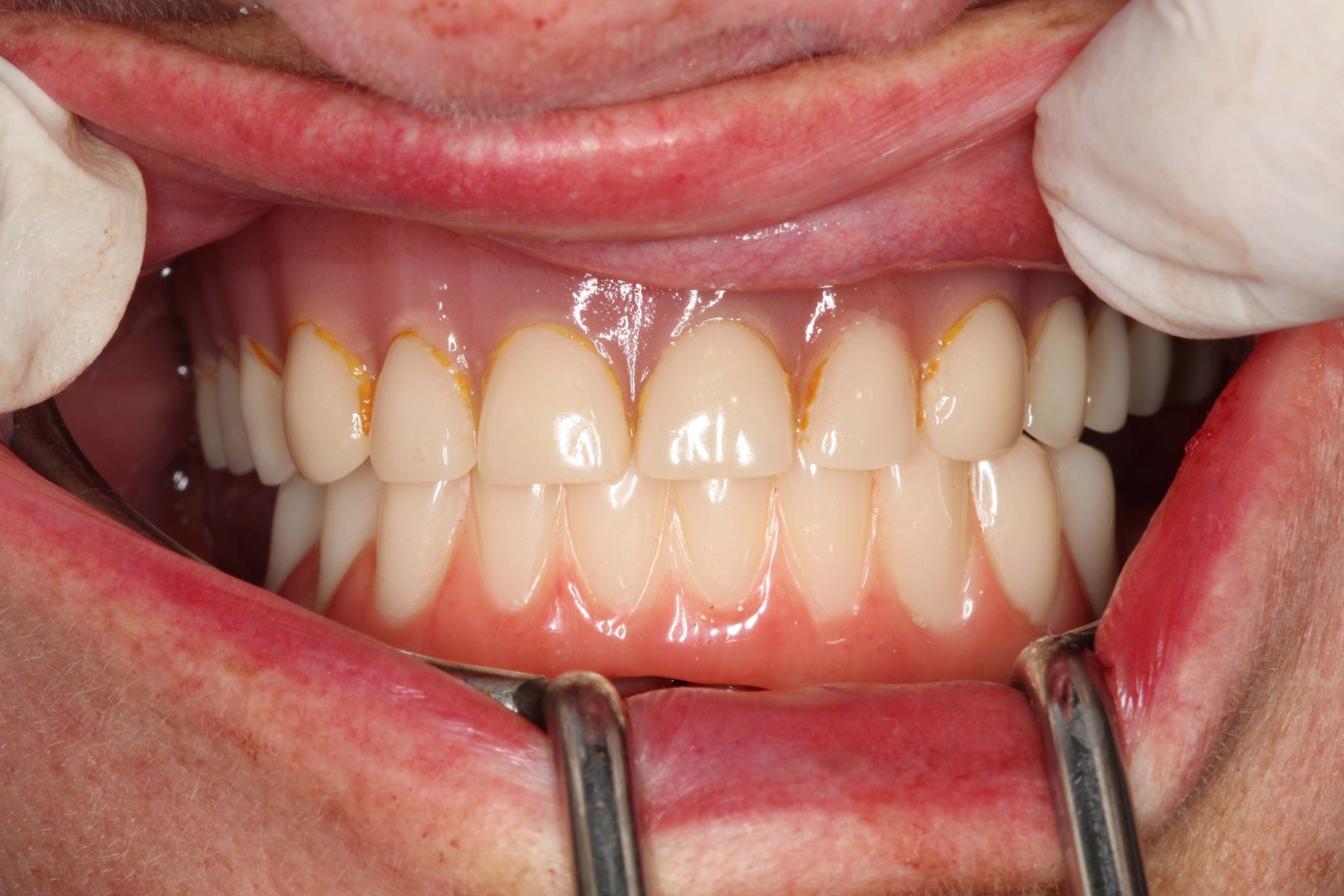 Straumann Pro Arch Konzept im atrophen Unterkiefer