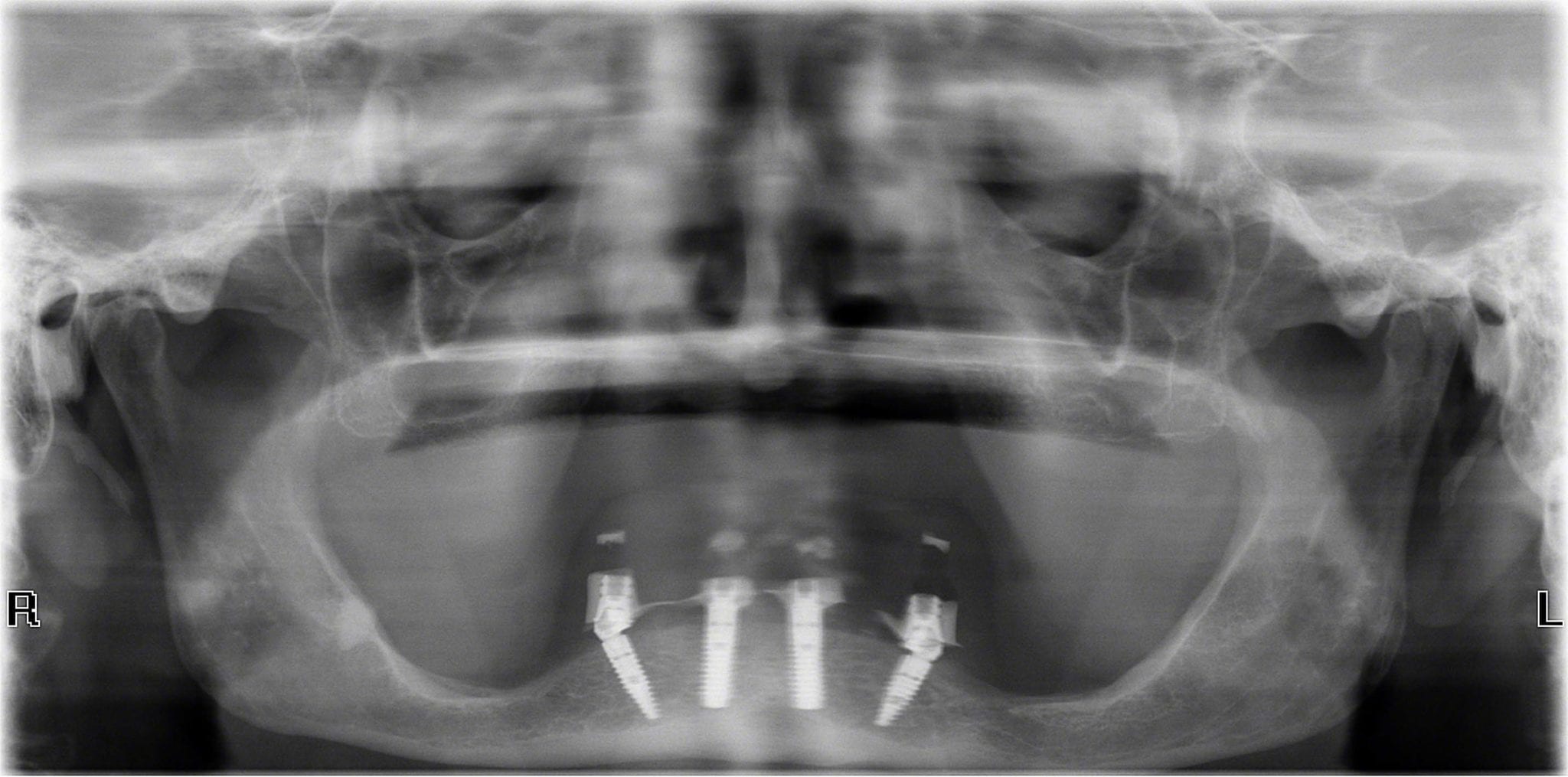 Straumann Pro Arch Konzept im atrophen Unterkiefer