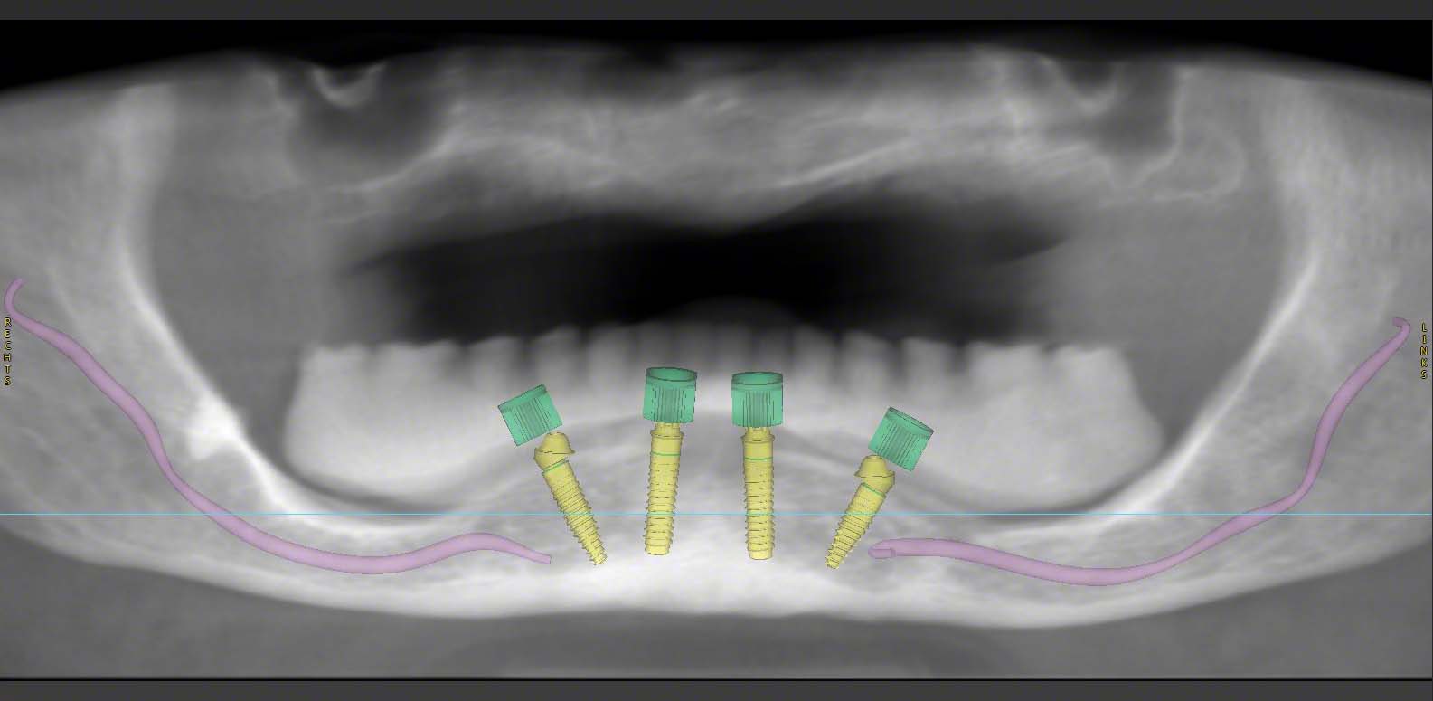 Straumann Pro Arch Konzept im atrophen Unterkiefer