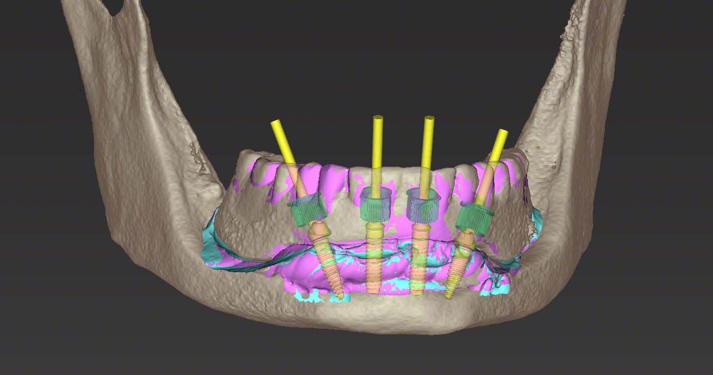 Straumann Pro Arch Konzept im atrophen Unterkiefer