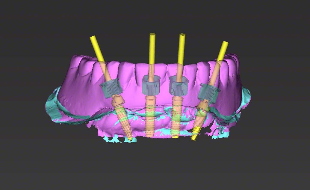Straumann Pro Arch Konzept im atrophen Unterkiefer